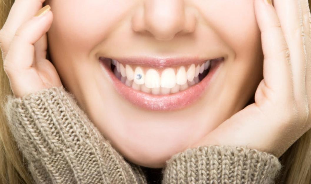 Zahnschmuck | Dr Salmo Fouad